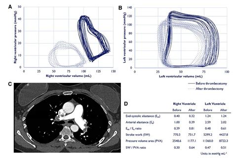Patrick Sullivan On Linkedin Pvloop Tct2022 Pvloops Hemodynamics