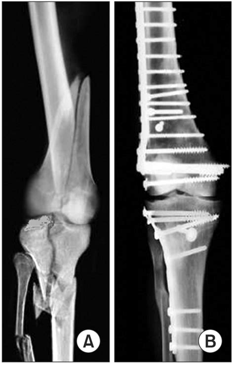 Floating Knee Femur At Jerry Saffold Blog