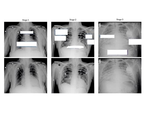 Cxr Cardiogenic Pulmonary Edema Stages 1 3 Quiz