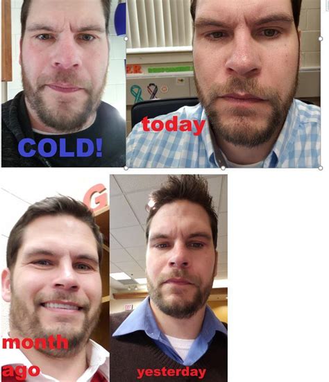 Is This Rosacea Or Reaction To Differin R Rosacea