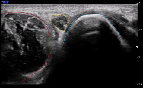 Dynamic Ulnar Nerve Dislocation