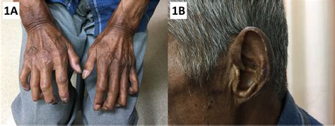 Addison Disease Skin Pigmentation Pictures Quotes Trending