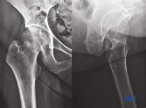 Impacted Or Nondisplaced Subcapital Femoral Neck Fractures