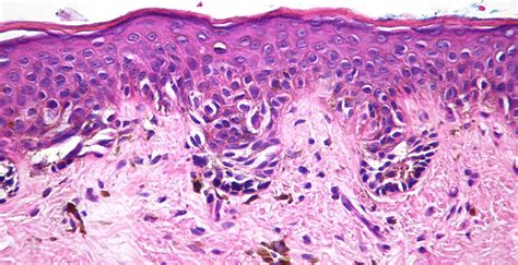 Higher Power View Showing Nesting Of Small Melanocytes With Download Scientific Diagram