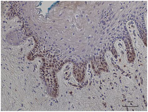 Hpv E7 Protein Expression Identified In Hpv Type 18 Positive Cervical Download Scientific