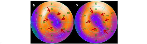 polar map reconstruction of the myocardial perfusion spect of a patient