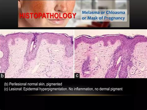 Disorders Of Hyperpigmentation Pptx