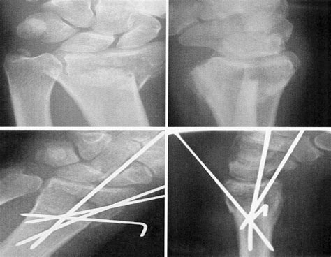 Distal Radius Fracture Kapandji Intrafocal Pinning Technique