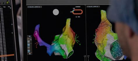 Atrial Tachycardia Bayside Heart