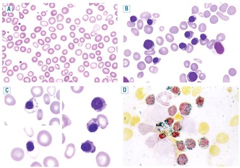 Ring Sideroblasts And Sideroblastic Anemias Haematologica
