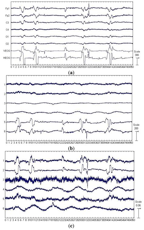 Eog Artifact Correction From Eeg Recording Using Stationary Subspace Analysis And Empirical Mode