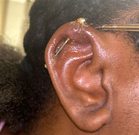 Piercing Bump On Ear Helix — Treatment Infection Granuloma Keloid Scar