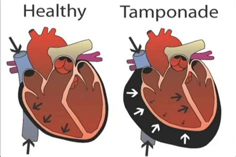 Cardiac Tamponade Pulsus Paradoxus Becks Triad Cardiac Nursing Cardiac Nursing Study