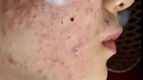 Pimple Popping 2020 Video 34 Blackhead Removal Whitehead Removal