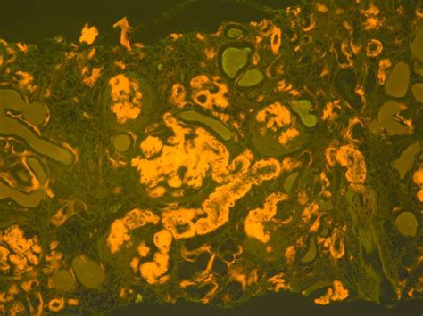 Workup Of Amyloidosis