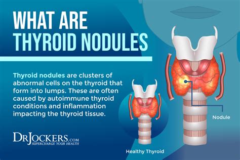 Thyroid Nodules Symptoms Causes And Support Strategies Ōmura Health