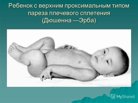 Паралич Эрба фото