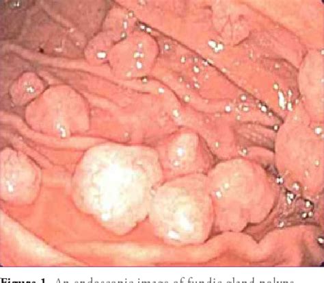 Figure 1 From Large Fundic Gland Polyps In The Stomach Semantic Scholar