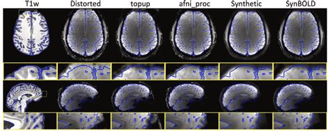 New Method To Correct Fmri Distortions Without The Need For Extra Scans