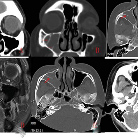 39 Years Female The First Preoperative Ct Revealed Hyperostosis And Download Scientific