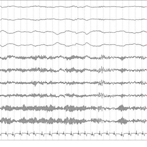 Occipital Dominance Of Alpha In Resting State Electroencephalography Download Scientific