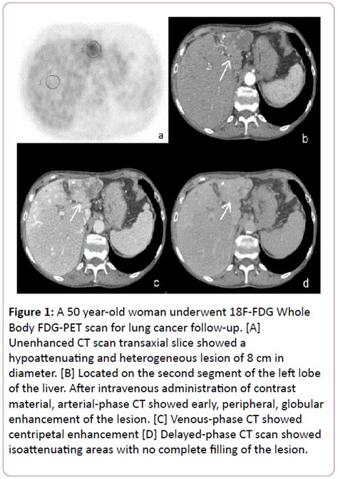 Cavernous Hemangioma Liver Ultrasound