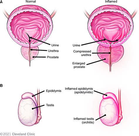 Epididymitis Symptoms In Women