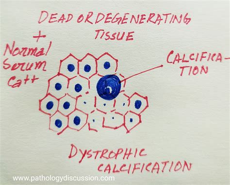 Faq On Pathologic Calcification Dystrophic Calcification Metastatic Calcification Psammoma Body