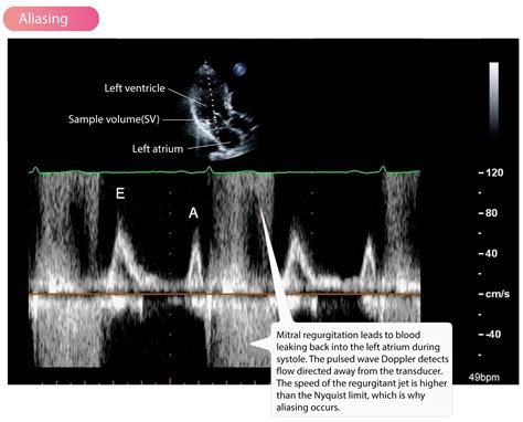 Continuous Wave Vs Pulse Wave Doppler Davis Plut1961