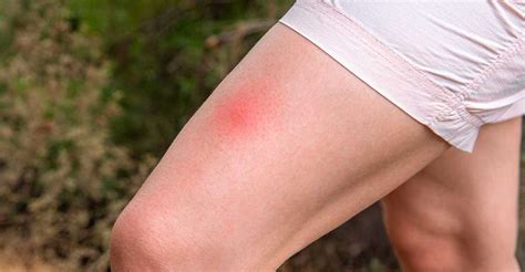 Tips For Preventing And Treating Insect Bites Laguna Urgent Care
