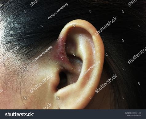 Seborrheic Dermatitis Where Ear Feels Itchy Foto Stock 1042021468 Shutterstock