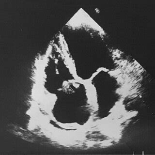 There Are Several Nodules In Both Lower Lobes Two Cavitated Nodule Is Download Scientific