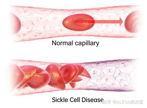 奥来恩药政前沿 Fda首次批准镰状细胞病（scd）的基因疗法（gt）！ 知乎