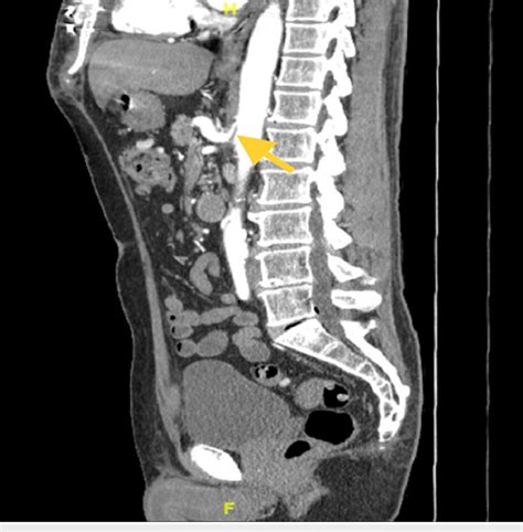 Sagittal View Computed Tomography Angiography Cta Of The Abdomen And Download Scientific