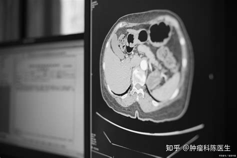 胶质母细胞瘤为什么那么恶？除手术外还有何治疗方法？ 知乎