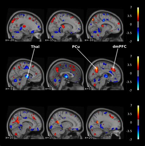Development And Validation Of A Multimodal Neuroimaging Biomarker For Electroconvulsive Therapy