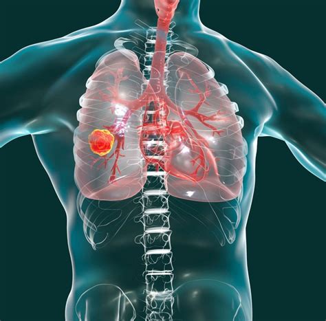 What Are Lung Cysts And Do They Require Treatment Dr Mohan