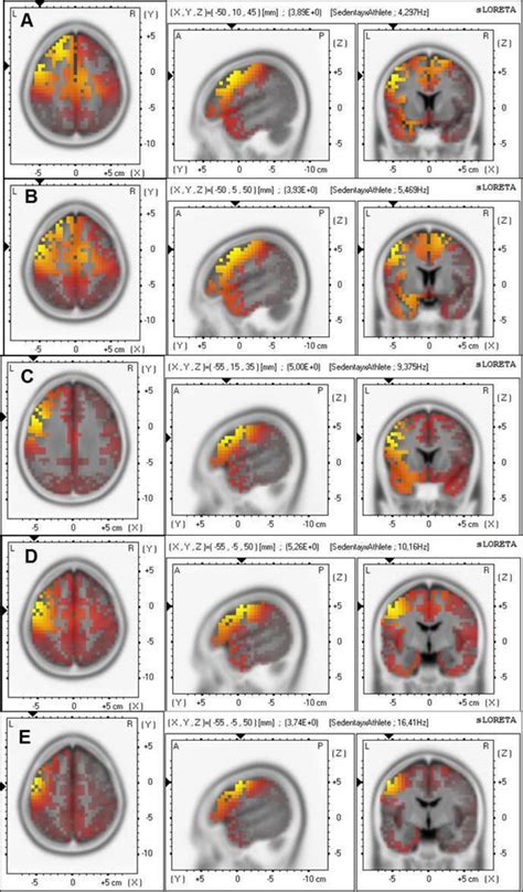 Resilience Psychological Characteristics And Resting State Brain