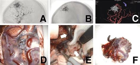 Preoperative Embolization Using Onyx In A 20 Year Old Female A Download Scientific Diagram