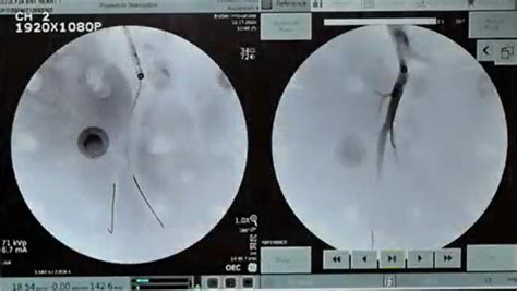 Bifurcation Stent Delivery System At Biosim Webinar