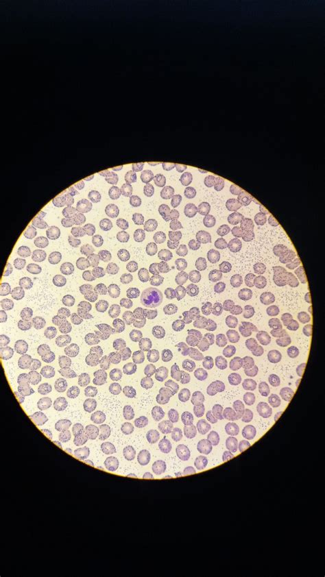 Eritrocitos Y Eosinofilos