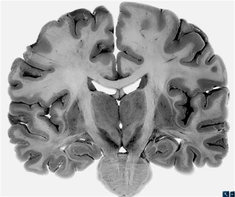 Coronal Slice 1 Diagram Quizlet