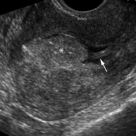Endometrial Polyp Longitudinal Image From A Transvaginal Download Scientific Diagram