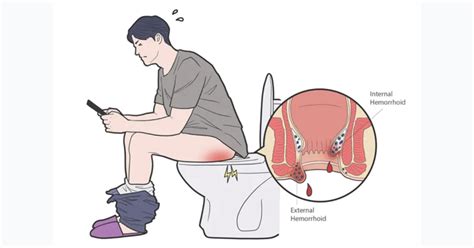 Hemorrhoids Vs Anal Fissures Differences And Treatments