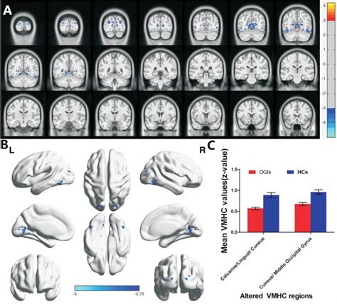 Reduction In Interhemispheric Functional Connectivity In The Dorsal