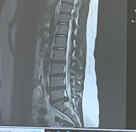 234 Best R Sciatica Images On Pholder L5 S1 Disc Herniation Mri