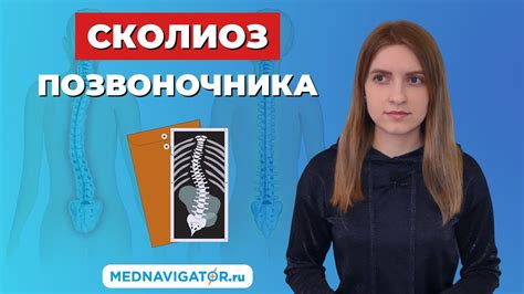 Сколиоз 1 2 и 3 степени фото симптомы лечение причины