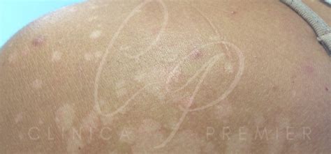 Pitiriasis Versicolor Dermatólogo Palma