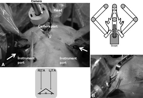 Harvesting Bilateral Internal Thoracic Arteries Using A Novel Subxiphoid Approach Versus The