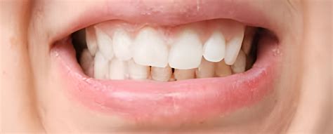 Especialista En Maloclusión En Tuxtla Gutiérrez Chiapas